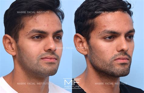 Chiseled Jawline Before And After