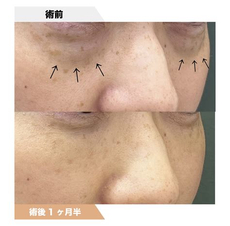 目の下のクマ Prpf注入療法 美容外科・形成外科 ジョイアクリニック京都 京都・烏丸御池
