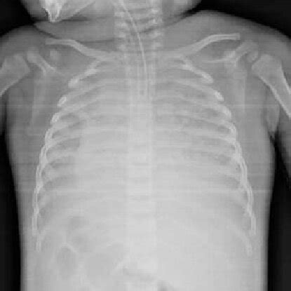 Bilateral Diffuse Pulmonary Infiltrates Are Seen At Presentation