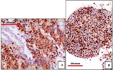 A Bl Of The Duodenum Diffuse Ebv Expression By In Situ Hybridization