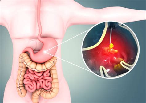 Cayenne Pepper Could Help Stomach Ulcers Acudetox Academy Online