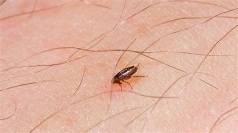 How To Treat Fleas In Human Hair Information And Facts Pest Samurai