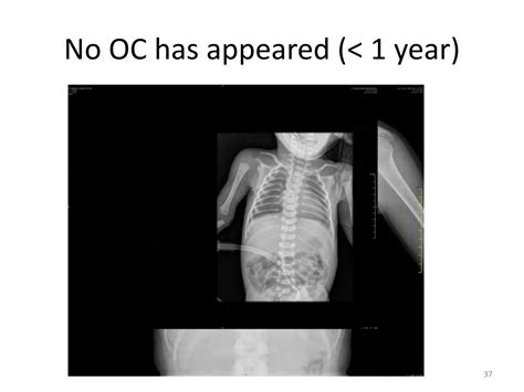 Age Estimation By Radiological Method Using X Rays Pptx