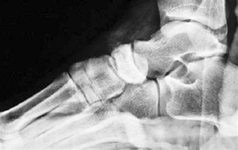 Immediate Postoperative Lateral Radiographic Inspection Showing The Download Scientific Diagram