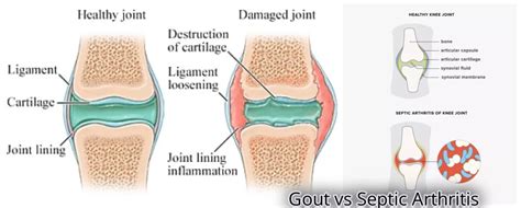 Gout Vs Septic Arthritis Difference Between Gout And Septic Arthritis
