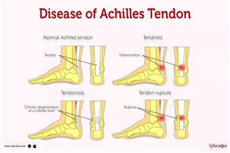 Achilles Tendon Human Anatomy Picture Function Diseases Tests