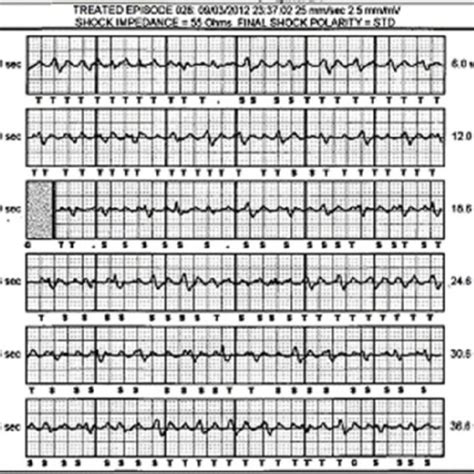 S ICD Downloads Demonstrating Over Sensing Of Atrial Flutter Download Scientific Diagram