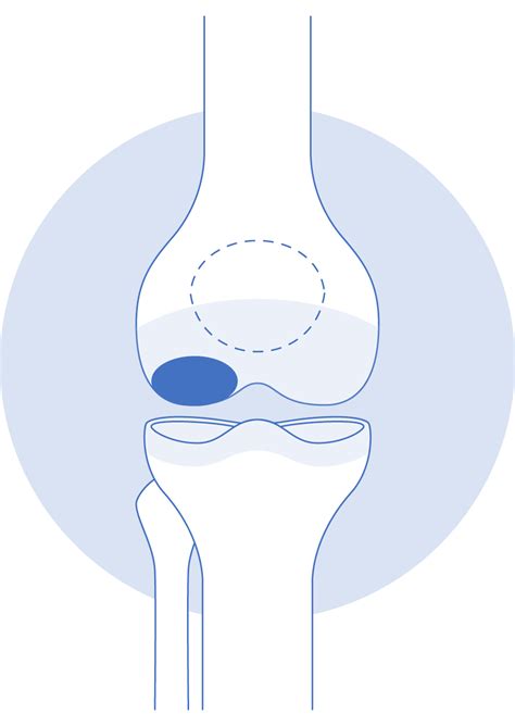 Knee Cartilage Regeneration Sven Knee Surgeon