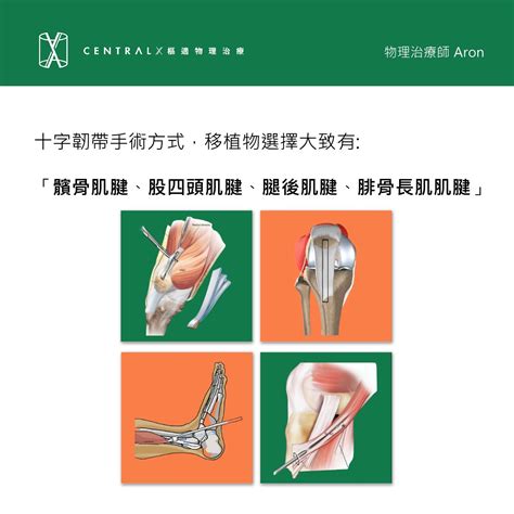 十字韌帶重建手術 除了腿後肌腱還有其他選擇嗎？ — 樞適物理治療 Central X Physical Therapy