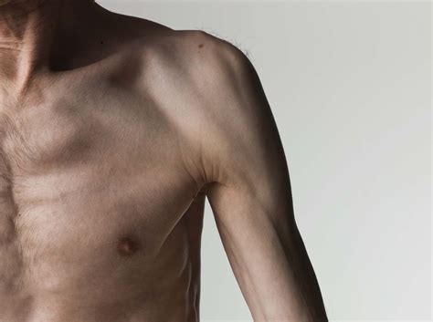 Testosterone And Hyperthyroidism