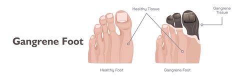 Gangrene Foot Symptoms Diagnosis And Treatment