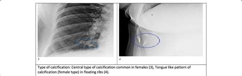Central Type Calcification Pattern Common In Females Download Scientific Diagram