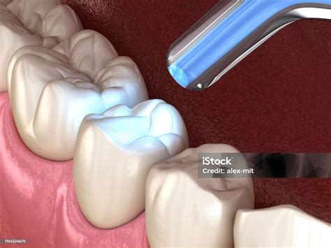 충 진 및 중 합 램프를 사용한 치아 복원 의학적으로 정확한 치아 3d 그림 3차원 형태에 대한 스톡 사진 및 기타 이미지 3차원 형태 디지털 생성 이미지 상감 세공
