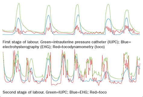 British Journal Of Midwifery Focus On Cardiotocography Intrapartum Monitoring Of Uterine