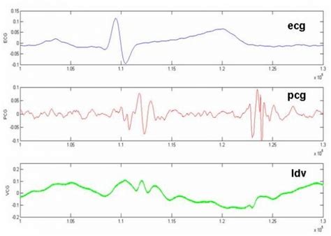 Phonocardiography Signal Processing Guypotent