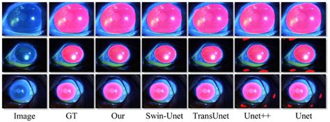 Performance Of Corneal Area Segmentation On Various Download