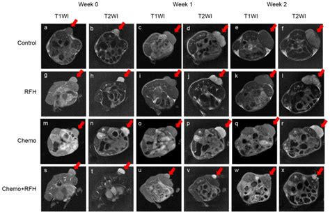 Radiofrequency Heat‑enhanced Direct Intratumoral Chemotherapy For