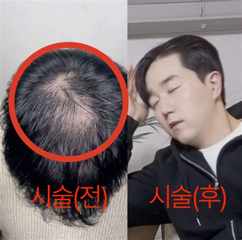 남자 헤어증모술 가격 가장 저렴하게 시술하는 방법 네이버 블로그