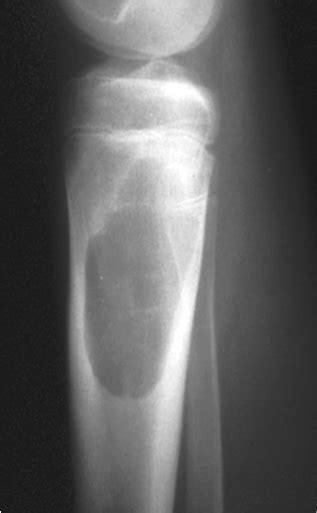Chondromyxoid Fibroma Pathology Orthobullets