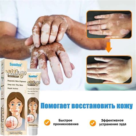 Мазь для лечения белых пятен на теле Крем для усиления пигментации при витилиго лейкодерма