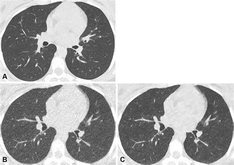 Ai Enhanced Ultra Low Dose Ct Detects Pneumonia Axis Imaging News