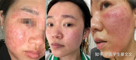 皮肤动不动就敏感发痒泛红过敏还有救吗敏感肌怎么修复皮肤屏障三甲医生总结过往案例1招教你烂脸急救轻松安抚皮肤情绪一键修复屏障肌