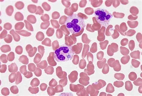 Pathology Outlines Anaplasma