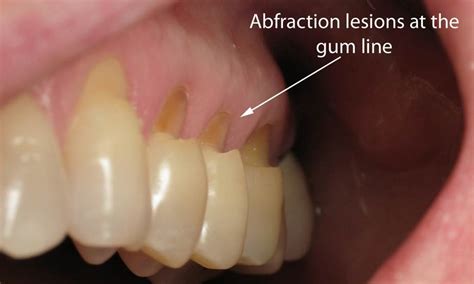 What Are Abfractions Smileinsight Dental San Diego Ca