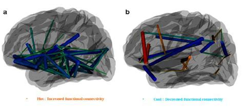 Altered Resting State Functional Connectivity In Schizophrenia And Download Scientific Diagram