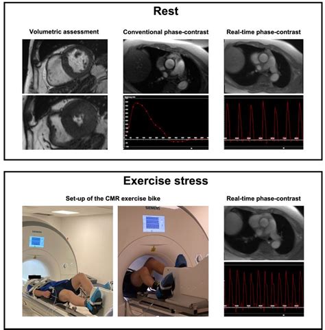 Assessment Of The Cardiac Output At Rest And During Exercise Stress Using Shehab Anwer