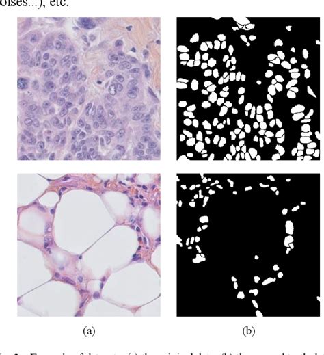 Figure 1 From Breast Cancer Detection From Histopathology Images Based On Yolov5 Semantic Scholar