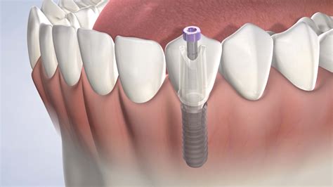 Post Operative Instructions Dental Implants At Alpine Surgical Arts