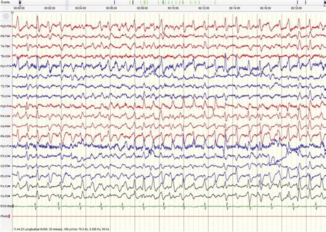 Electroencephalography Shows Triphasic Waves With No Alpha Rhythm
