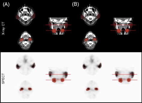 Quantitative Salivary Gland Spectct Using Deep Convolutional Neural Networks Abstract