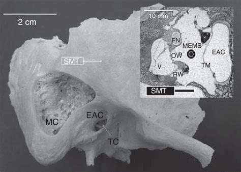 Aspect Of A Temporal Bone Showing A Mastoidectomy Cavity MC And Other Download Scientific