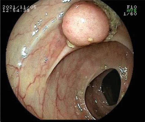 Figure 1 From Post Polypectomy Coagulation Syndrome A Tricky To Diagnose Hot Snare Problem That