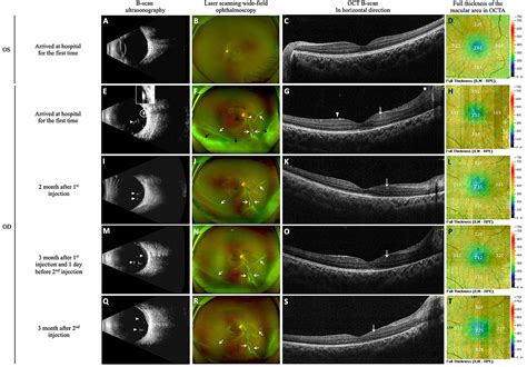 Frontiers Case Report Ultrasound Biomicroscopy As A Guide For The Selection Of Injection
