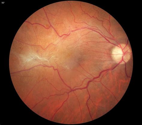 Researchers Identify Progression Pattern Of Myopic Tractional Maculopathy