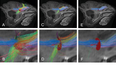 Diffusion Spectrum Imaging Semantic Scholar