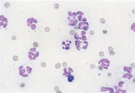 Centesis Fluid Classification Flashcards Quizlet