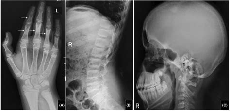 Skeletal Survey For Hyperparathyroidism A Radiograph Of Left‐hand Download Scientific