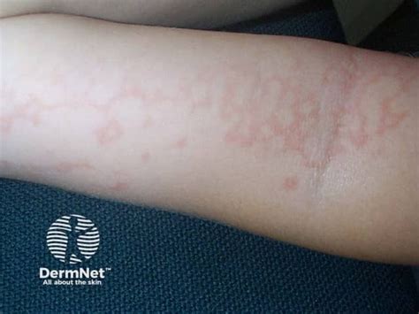 Erythema Infectiosum Lacy Rash