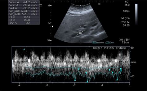 Homogeneous Echotexture Of Liver In Normal Individual Mean Pv Velocity