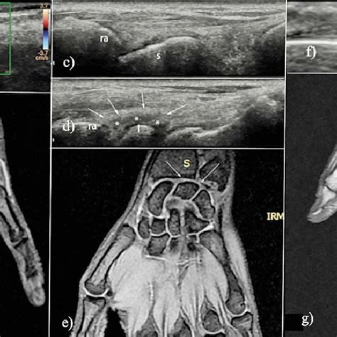 Female 32 Years Old 3rd Mcp Joint A Longitudinal Ultrasound With Download Scientific
