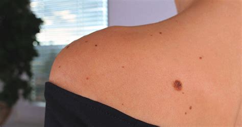Nevus Definition Common Types Photos Diagnosis And Treatment