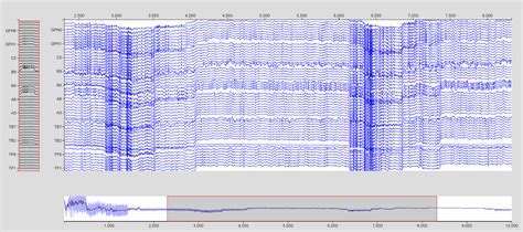 Modeling Epilepsy — Tvb 2 3 16440 Documentation