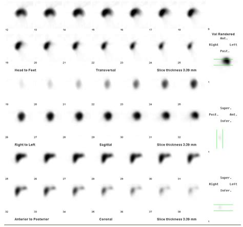 Follow Up Technetium Scan At 2 Years Of Age Showed Download Scientific Diagram