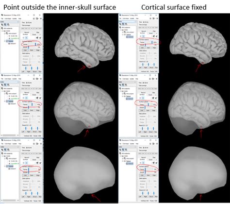 an outlier in head model computed by openmeeg bugs brainstorm