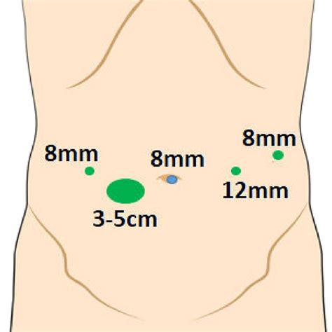 Operating Room Setup For Robotic Liver Resection Download Scientific Diagram