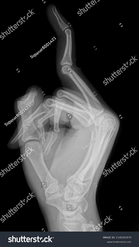 Middle Finger Xray Side View Stock Photo Shutterstock
